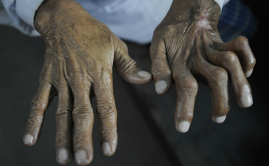 The Leprosy Mission England and Wales | Disabled - Health Charities ...